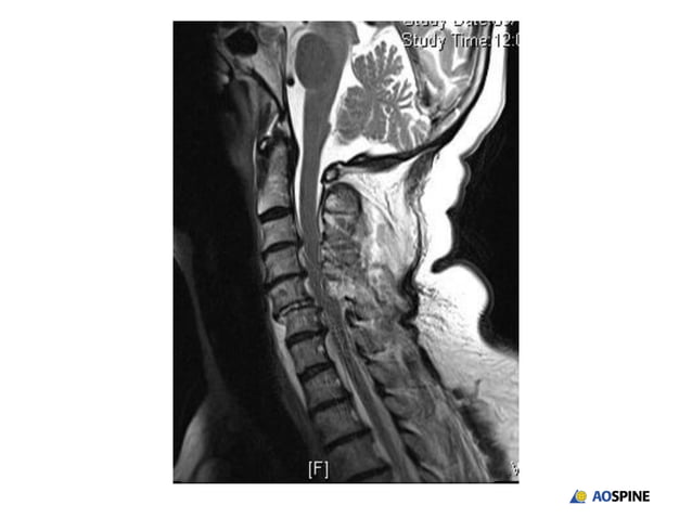 Unifacet dislocation MRI | PPT