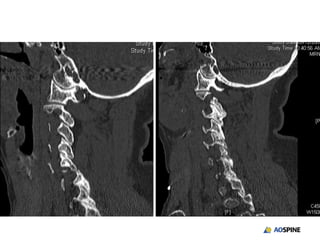 Unifacet dislocation MRI | PPT