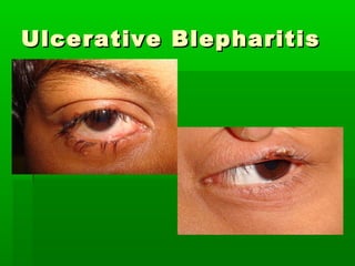 Ulcerative Blepharitis
