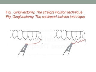 procedures of periodontal surgery(gingival surgery), WOLAITA SODO ...