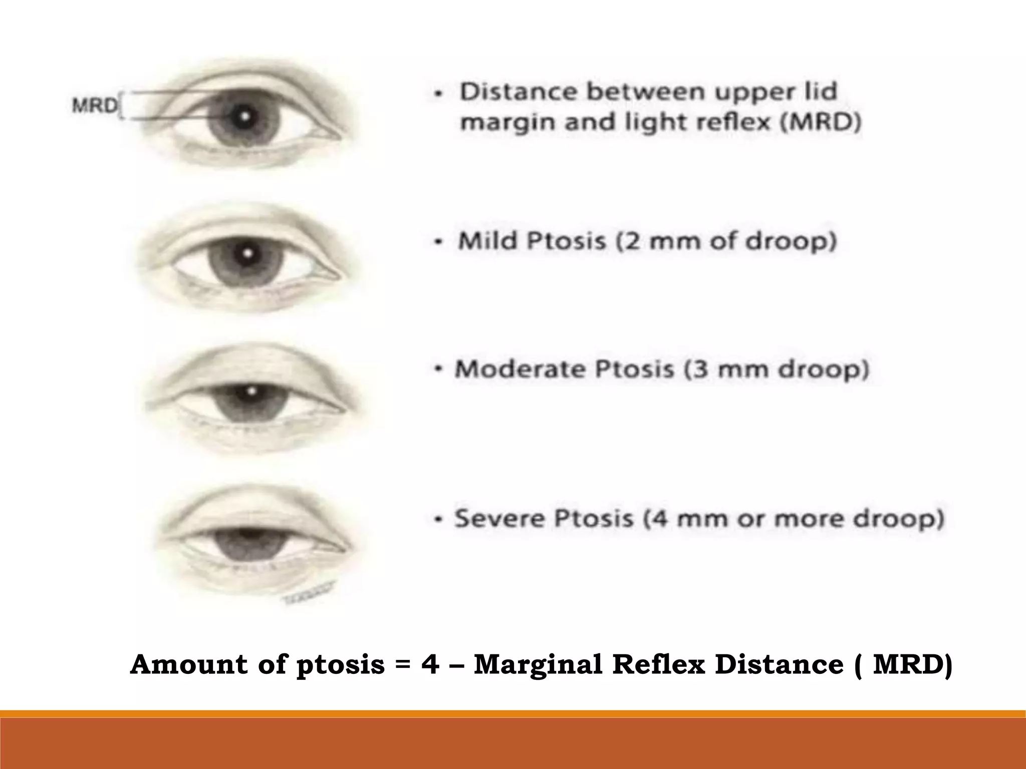 lid examiantion.pptx