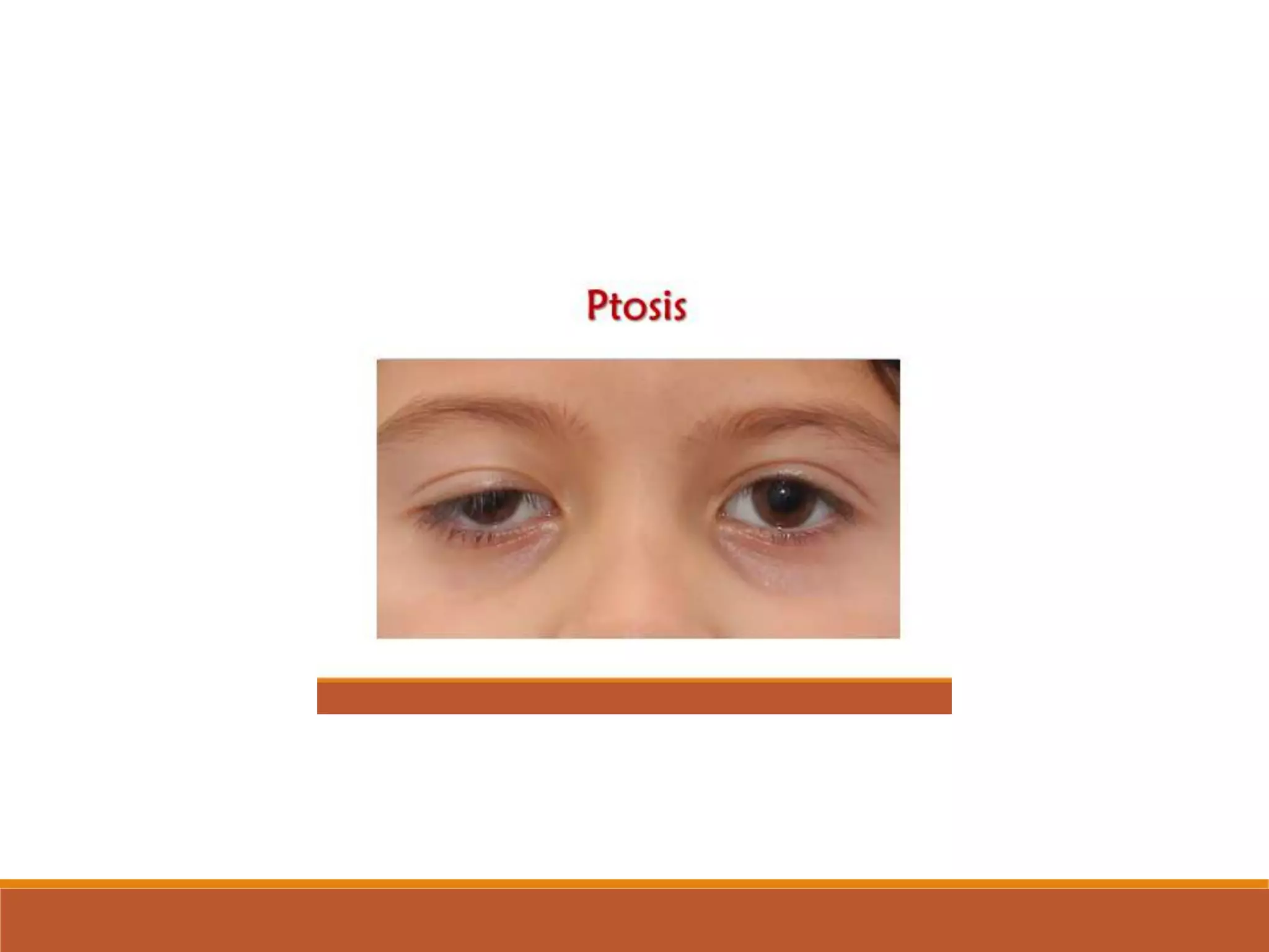 lid examiantion.pptx