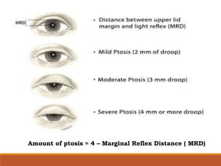 lid examiantion.pptx