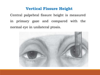 lid examiantion.pptx
