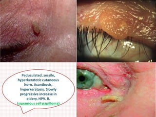 Lid lesions | PPTX