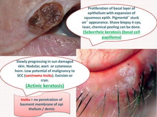 Lid lesions | PPTX