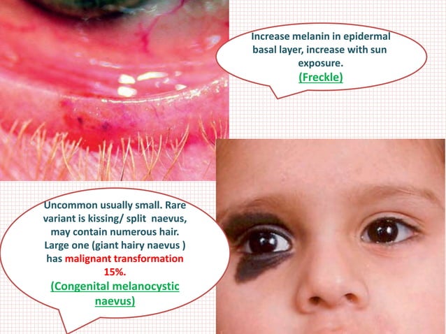 Lid lesions | PPTX | Skin and Dermatology | Diseases and Conditions