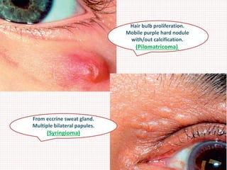 Lid lesions | PPTX