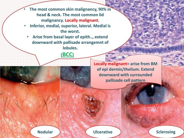 Lid lesions | PPTX | Skin and Dermatology | Diseases and Conditions