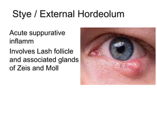 Lid Pathologies.pptx