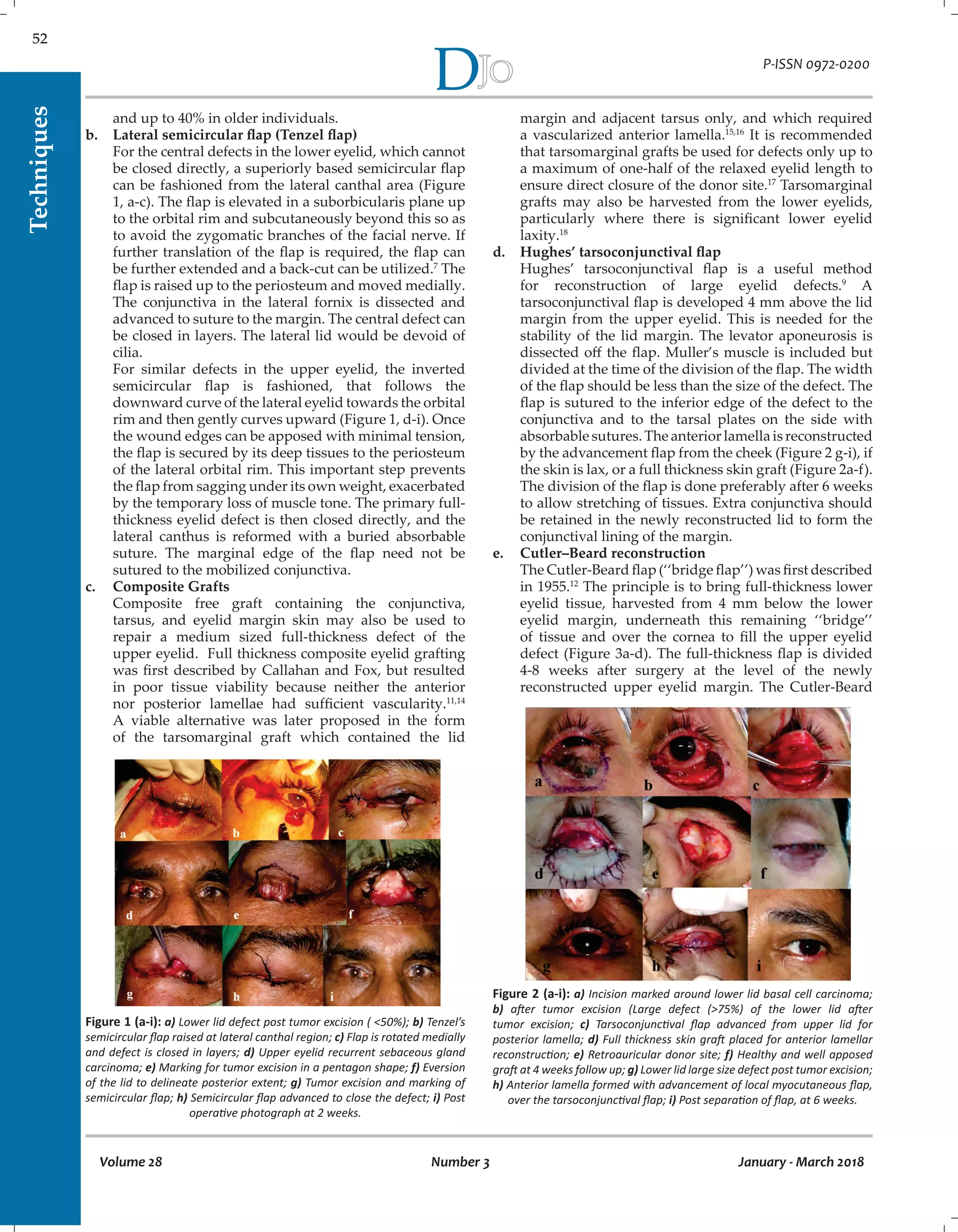 Lid reconstruction | PDF