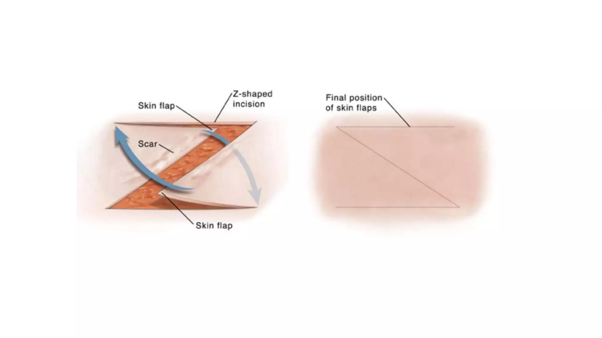 Lid retraction | PPTX