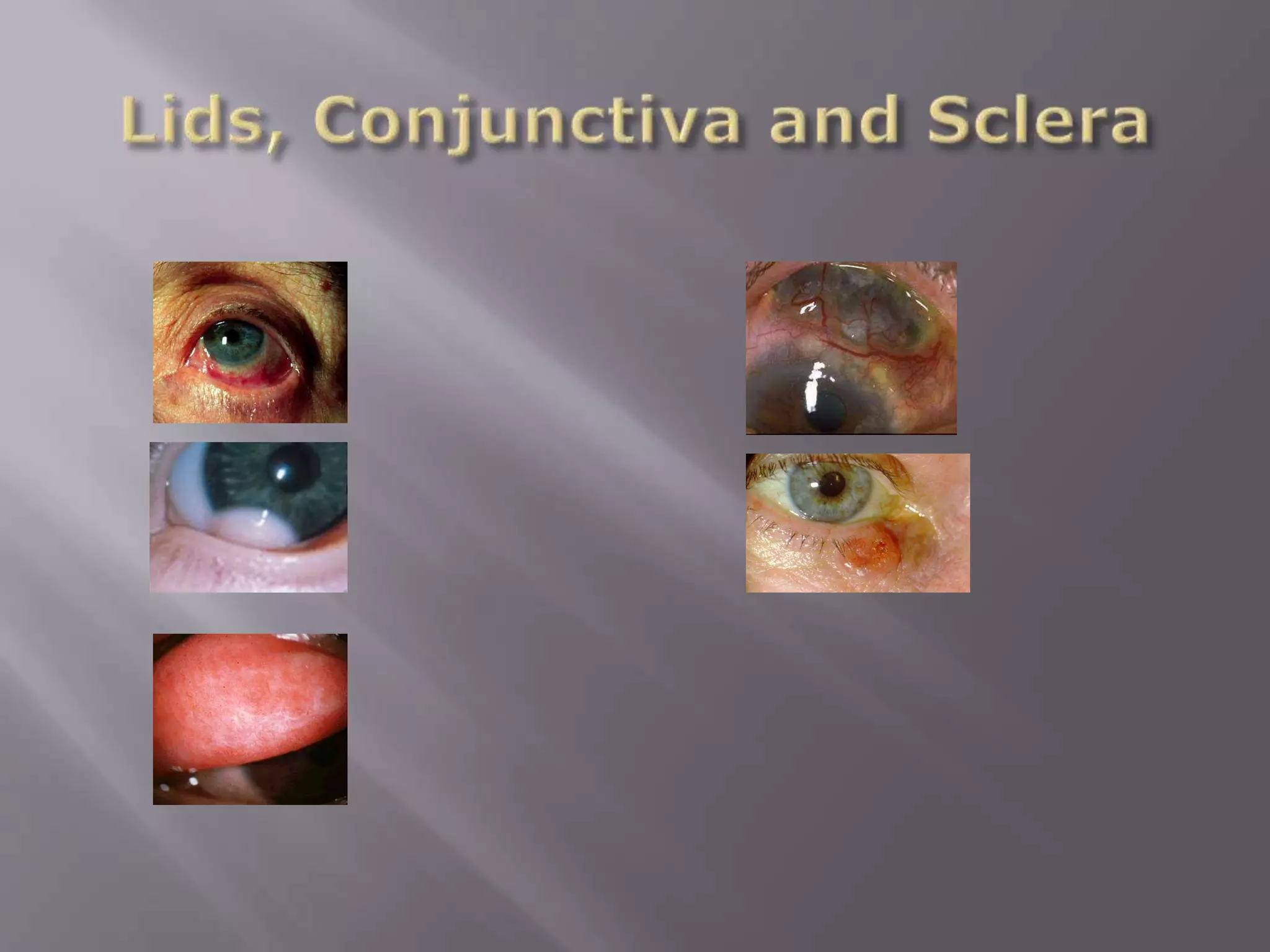 Common Cases: Lids, Conjunctiva and Sclera | PPT