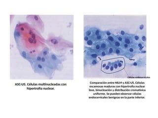 LESIONES INTRAEPITELIALES CERVICALES .pptx