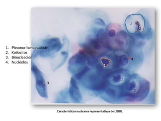 LESIONES INTRAEPITELIALES CERVICALES .pptx