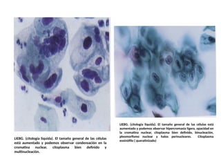 LESIONES INTRAEPITELIALES CERVICALES .pptx
