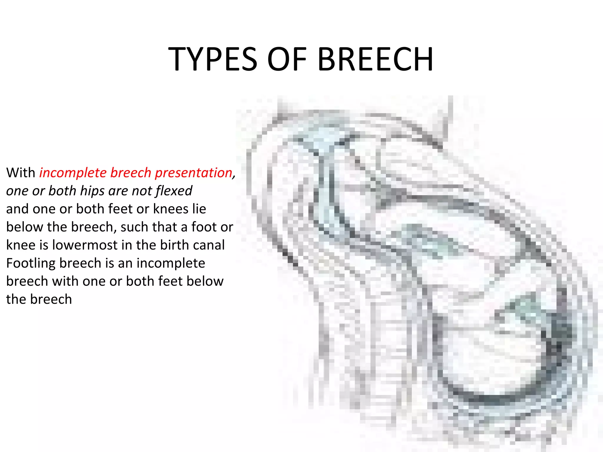 Lie, presentation, attitude, and position | PPT