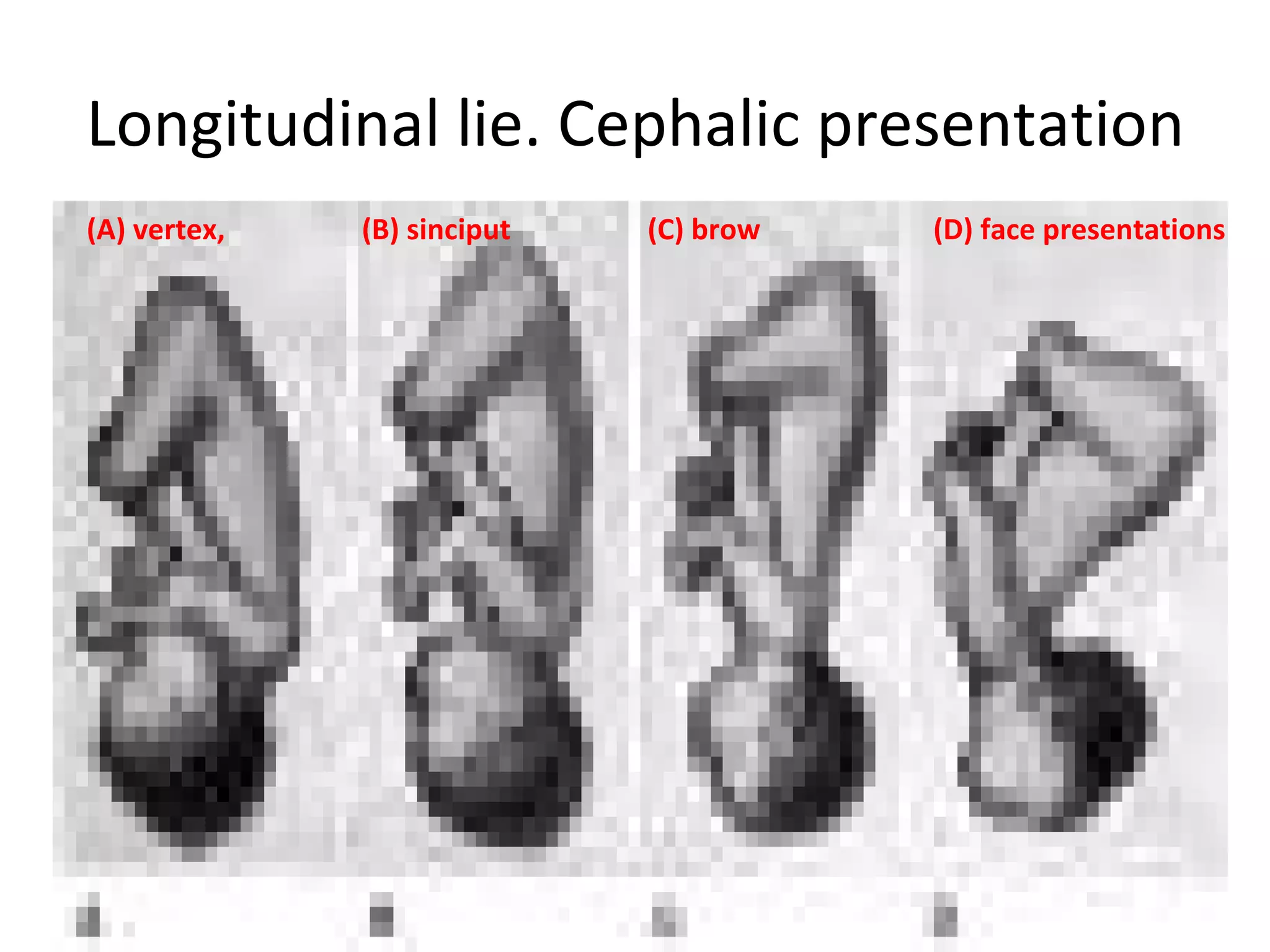 Lie, presentation, attitude, and position | PPT
