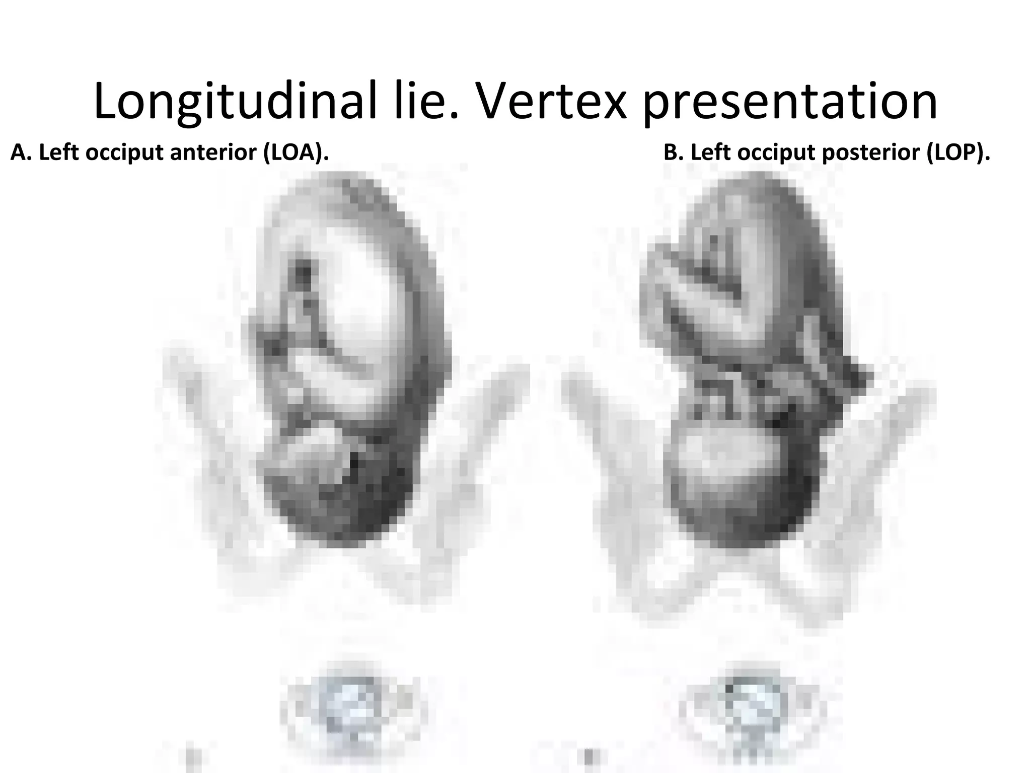 Lie, presentation, attitude, and position | PPT
