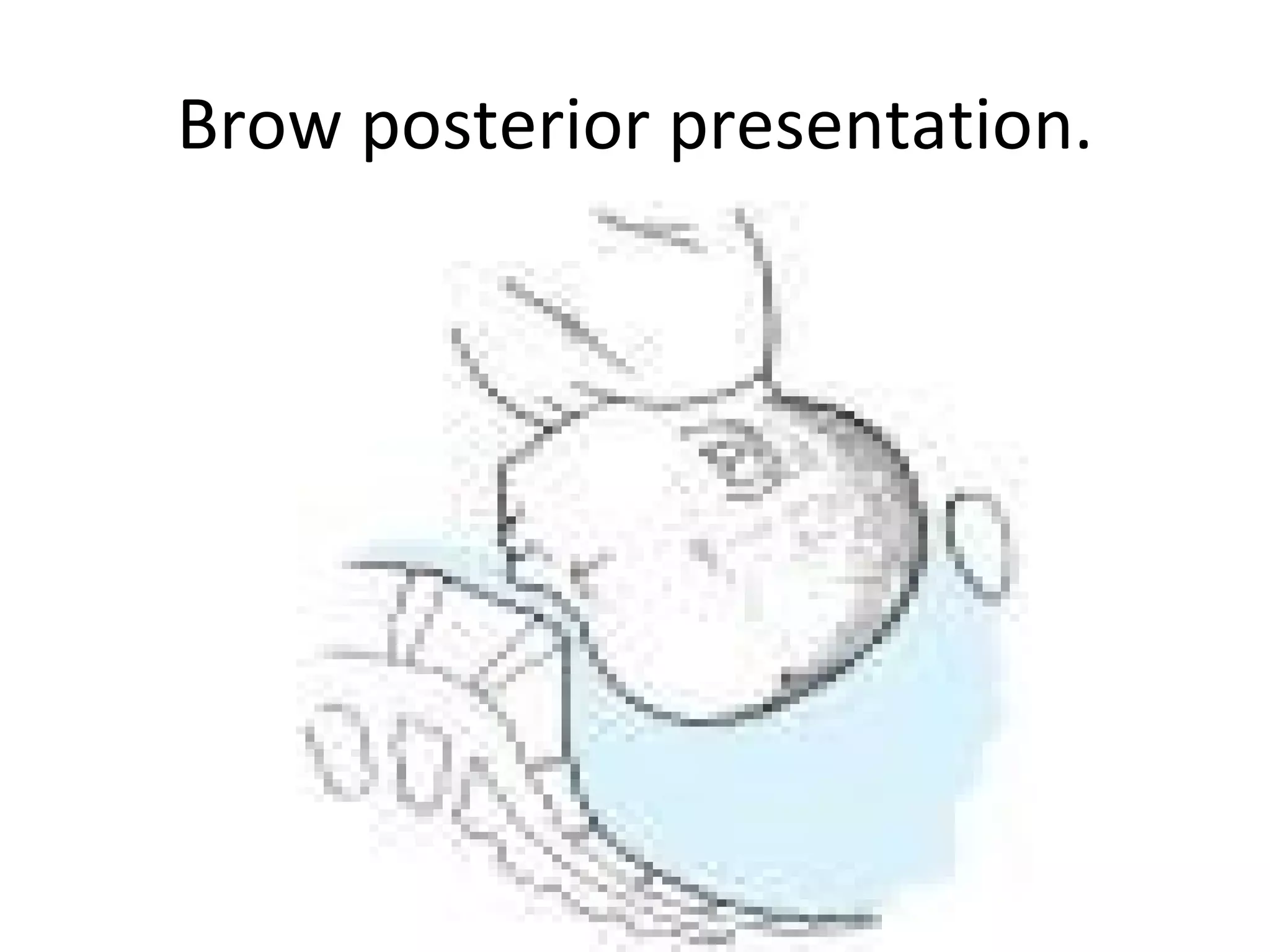 Lie, presentation, attitude, and position | PPT