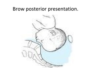 Lie, presentation, attitude, and position | PPT