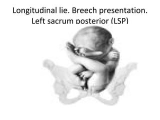 Breech Presentation Longitudinal Lie