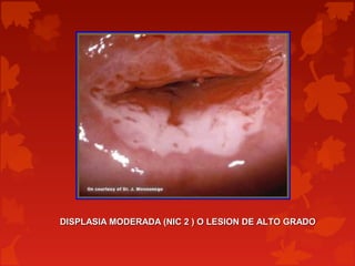 LESIONES INTRAEPITELIALES Y CA DE CUELLO UTERINO | PPT