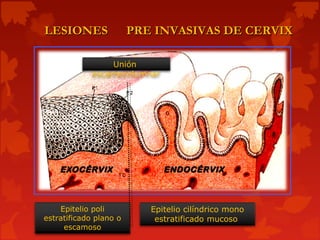 LESIONES INTRAEPITELIALES Y CA DE CUELLO UTERINO | PPT