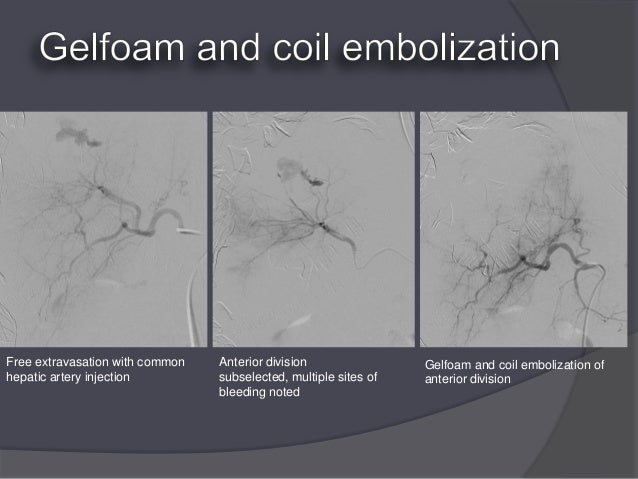 Life saving embolizations