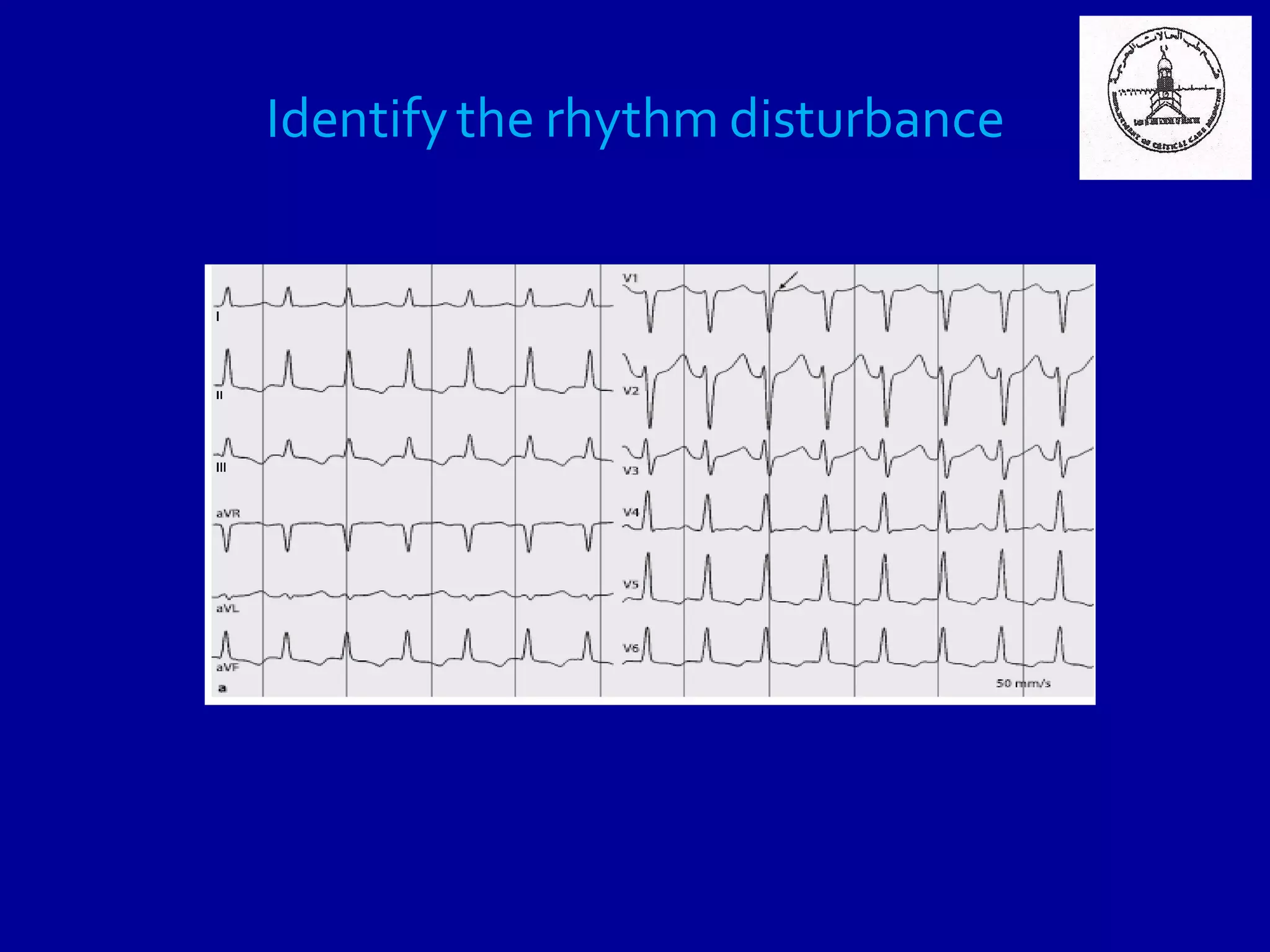 Life threatening arrhythmias in the ICU | PDF