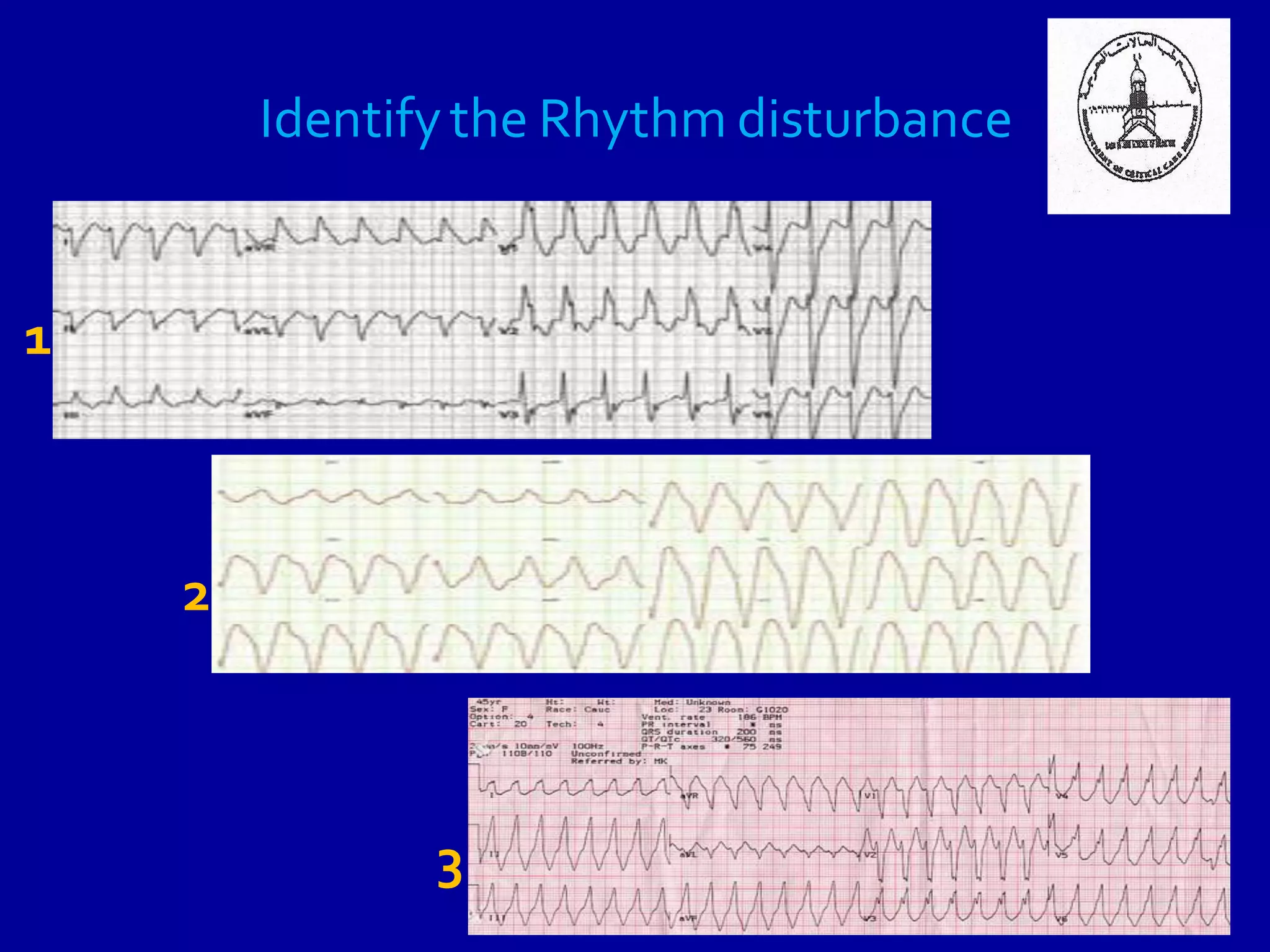 Life threatening arrhythmias in the ICU | PDF
