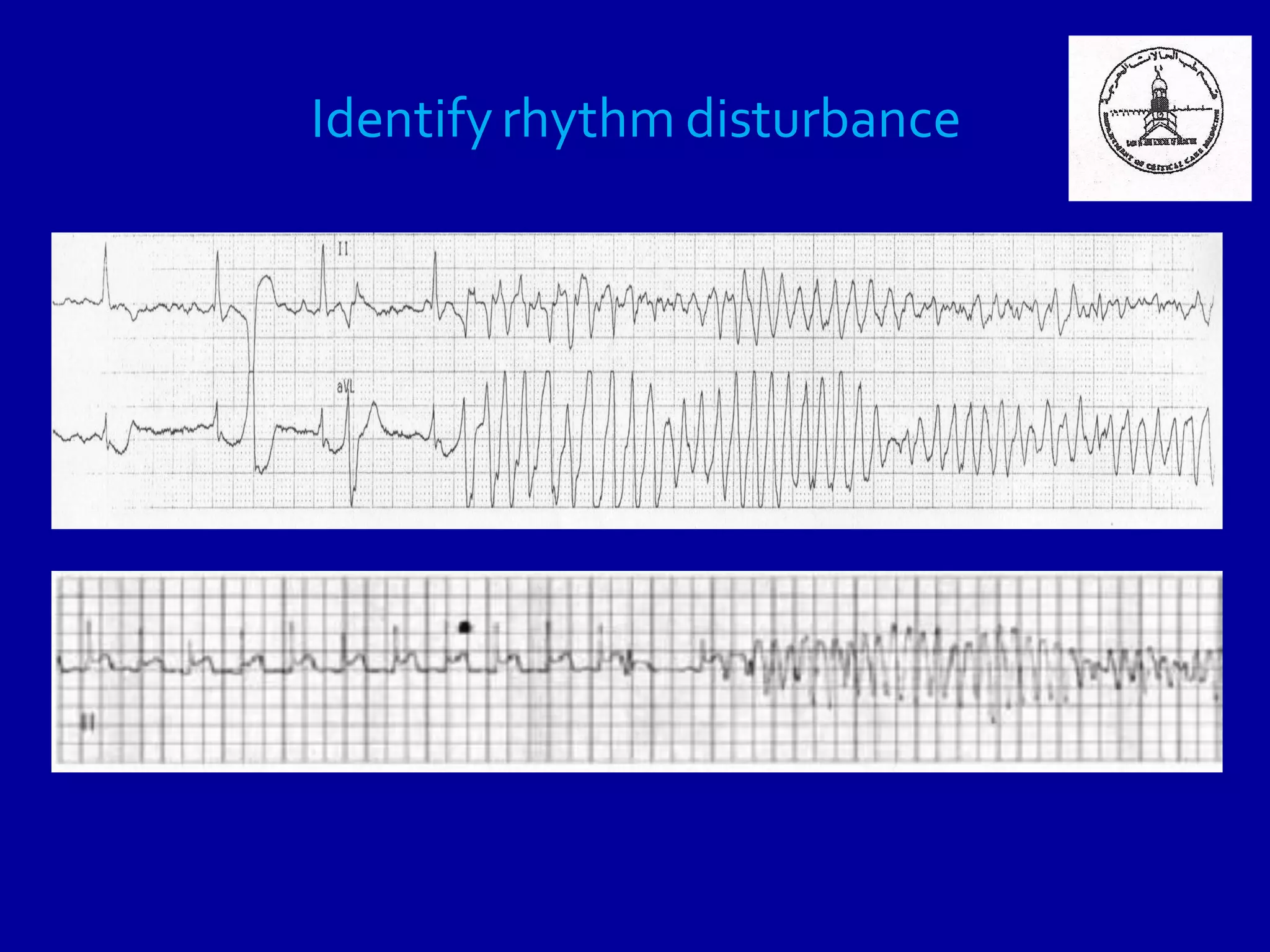 Life threatening arrhythmias in the ICU | PDF