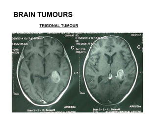 Life saving neurosurgery - | PPT