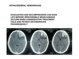 Life saving neurosurgery - | PPT
