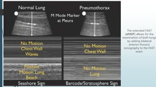 Life threatening chest trauma | PPTX | First Aid | Injuries
