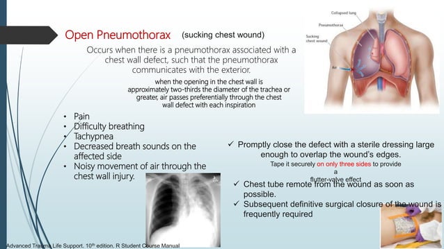 Life threatening chest trauma | PPTX | First Aid | Injuries