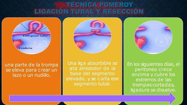 LIGADURA BILATERAL DE TROMPAS UTERINAS.pptx