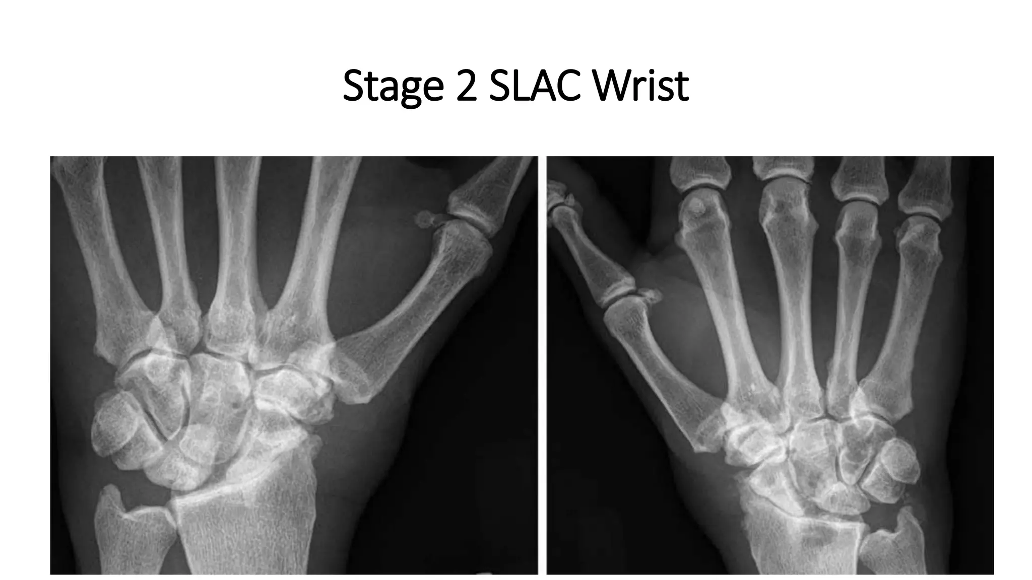 Ligament injuries of hand and wrist | PDF
