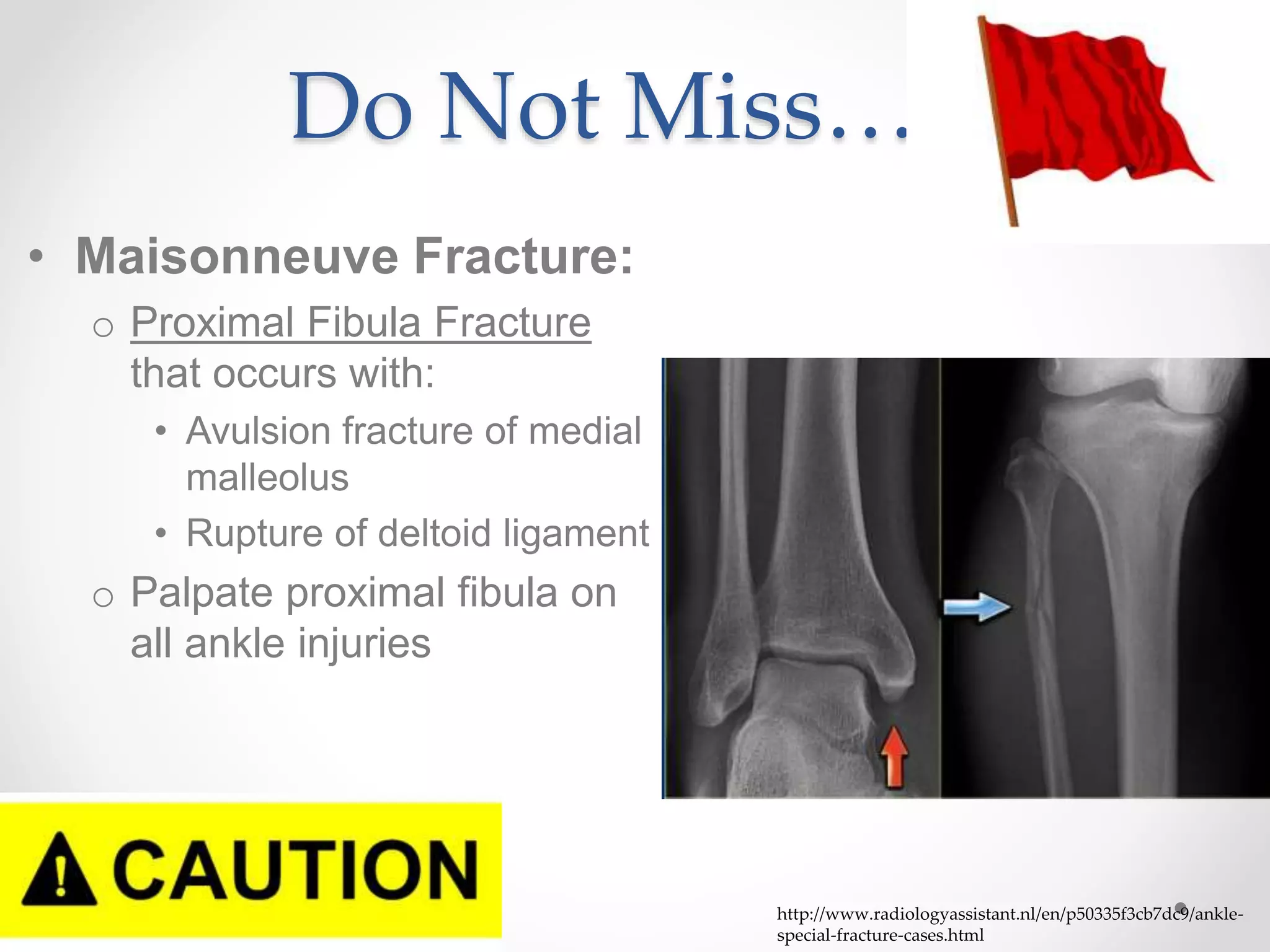 Ligament injury around ankle.pptx