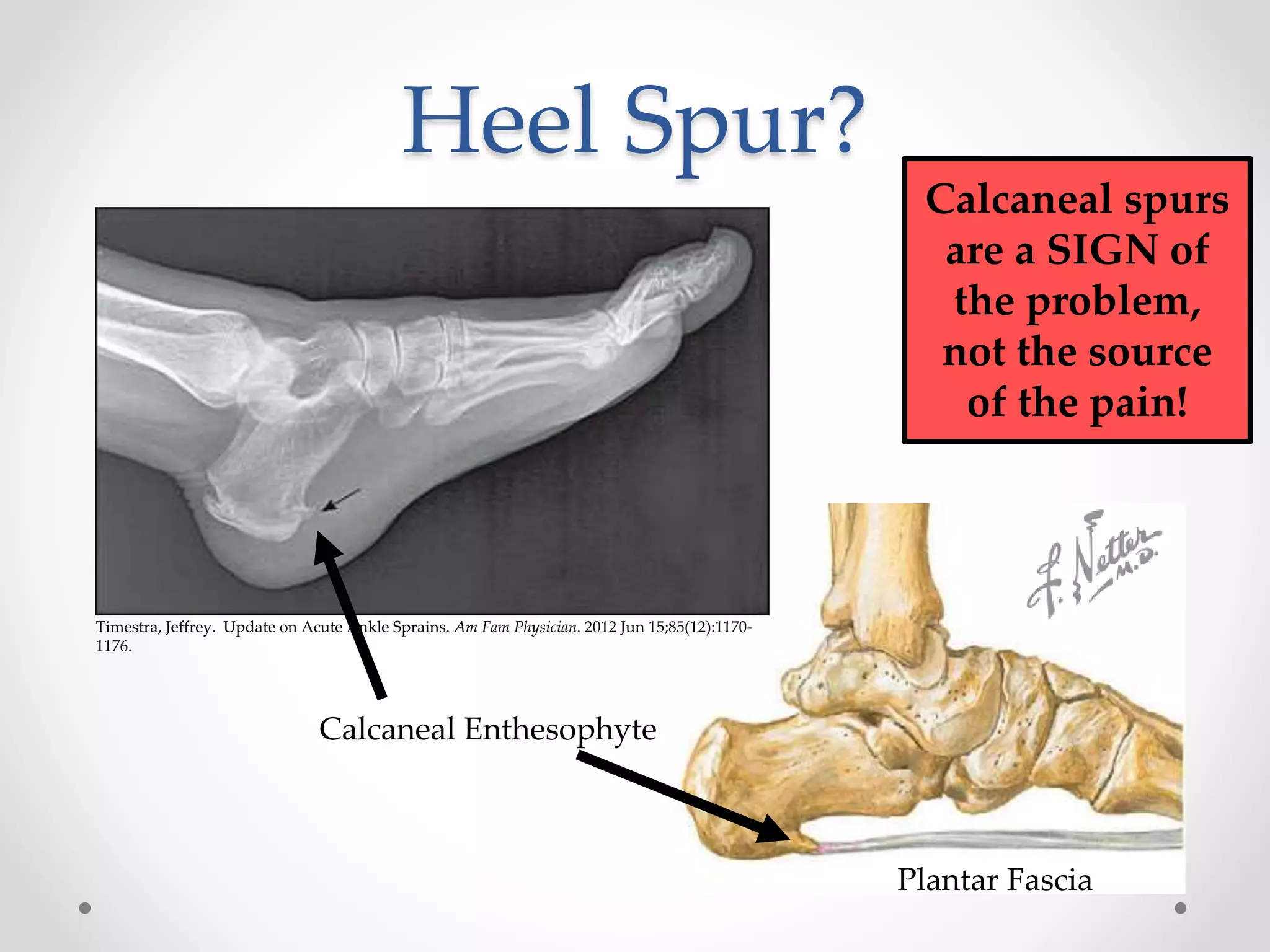 Ligament injury around ankle.pptx
