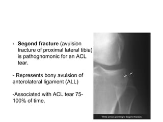Ligament injury to knee: ACL | PPTX