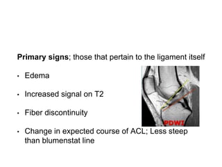 Ligament injury to knee: ACL | PPTX