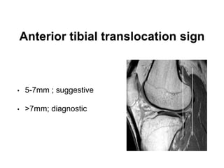 Ligament injury to knee: ACL | PPTX