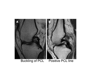 Ligament injury to knee: ACL | PPTX