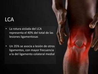 Ligamento cruzado anterior (lca) | PPTX