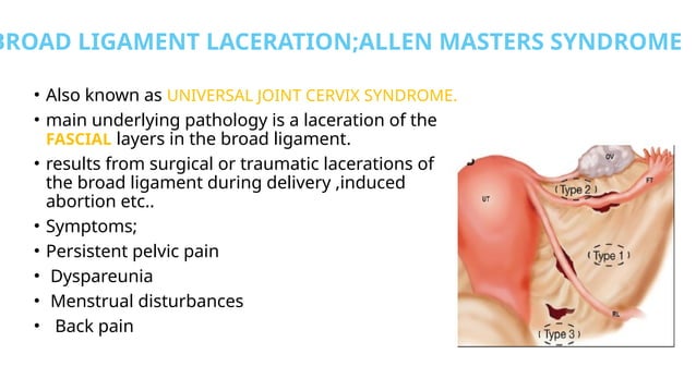 Ligaments of female genital tract .pptx