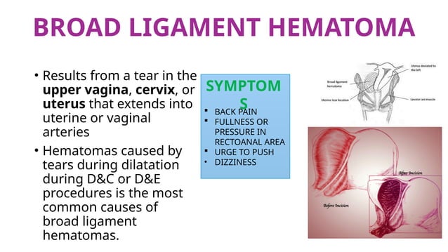 Ligaments Of Female Genital Tract Pptx 9869