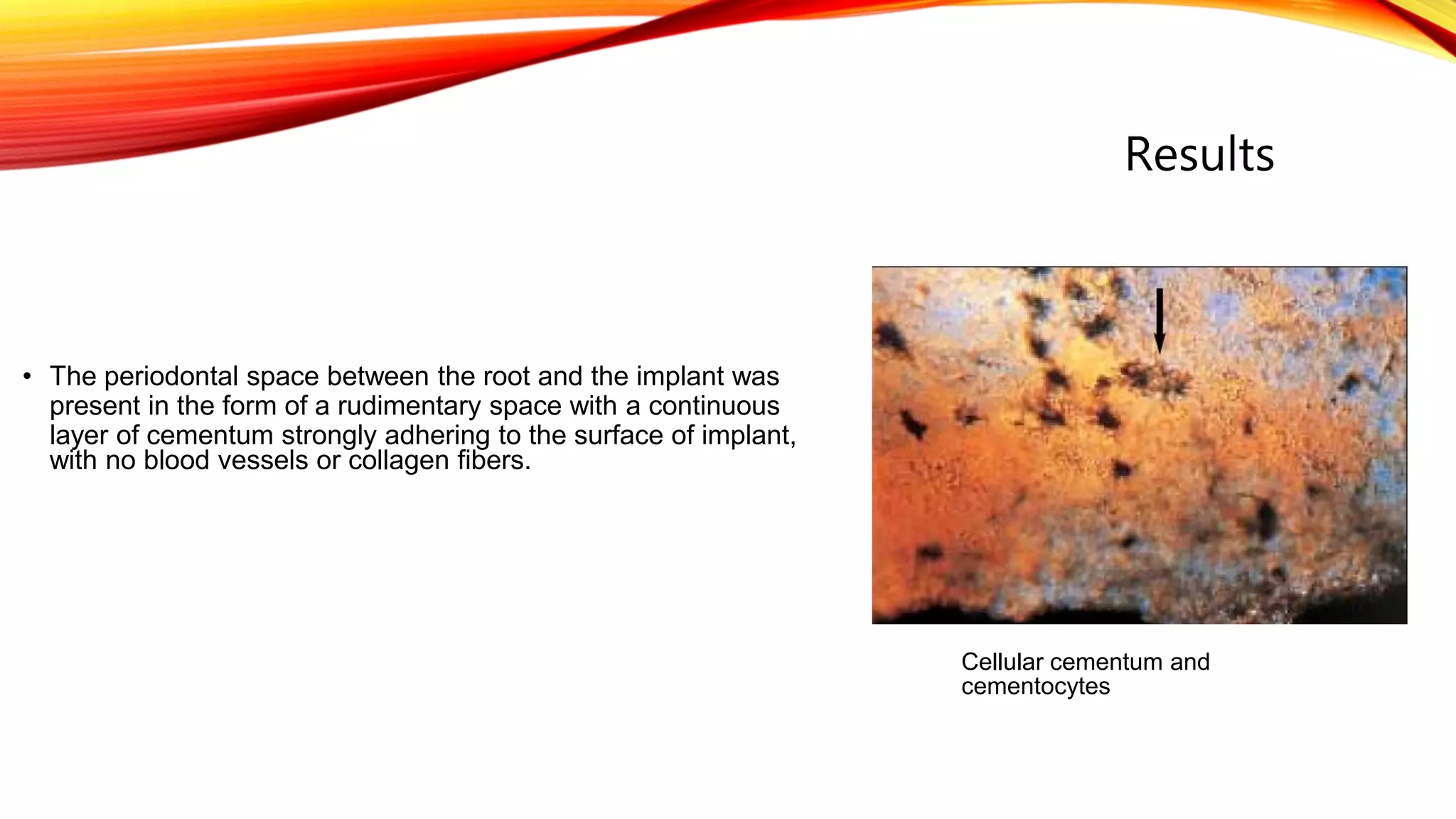 Ligaplants, the next‑generation prosthodontic implants | PPTX