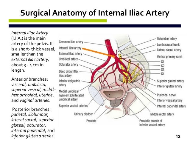 External Ligation of Internal Iliac Artery (E.L.I.I.A) - by Naira R.