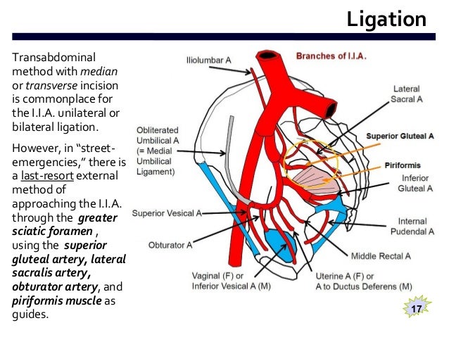 External Ligation of Internal Iliac Artery (E.L.I.I.A) - by Naira R.